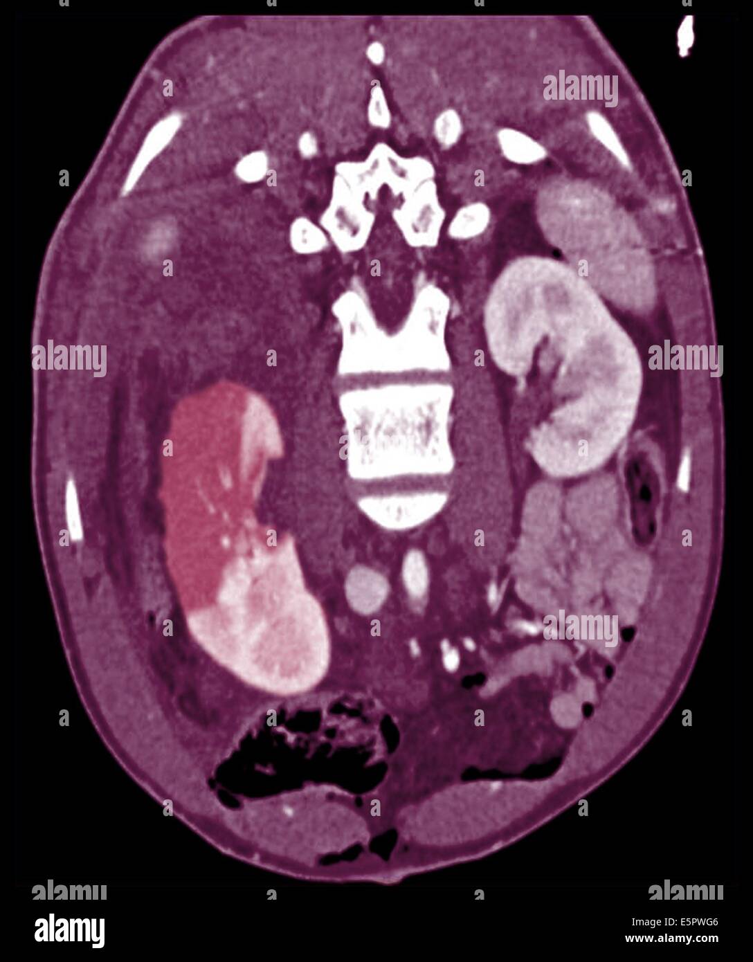 Oblique axial Compted Tomography (CT) scan of the the trunc showing a ...