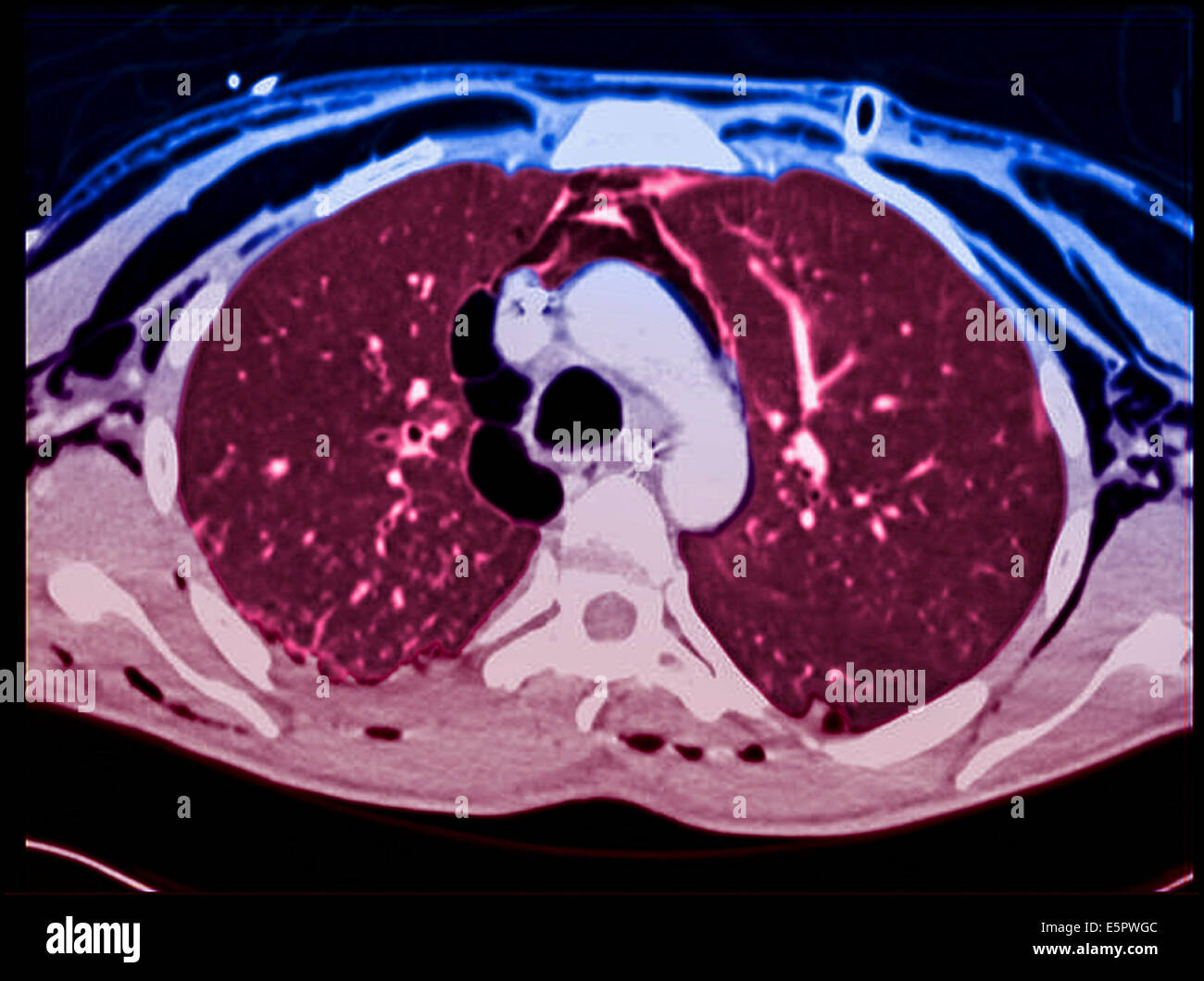 Ct of emphysema hi-res stock photography and images - Alamy