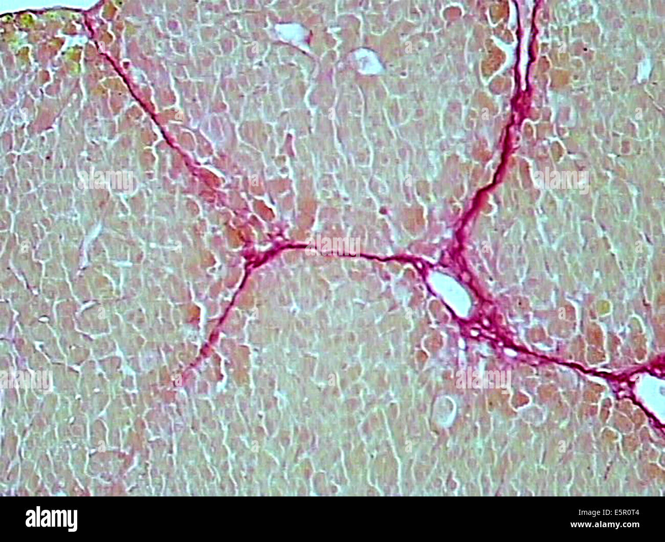 Photomicrograph of of liver tissu with collagen fibers in pink Stock ...