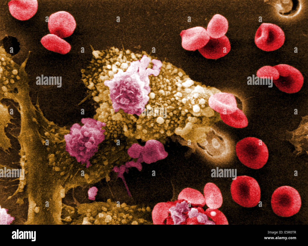 Scanning electron micrograph (SEM) of a cancer cell attacked by ...