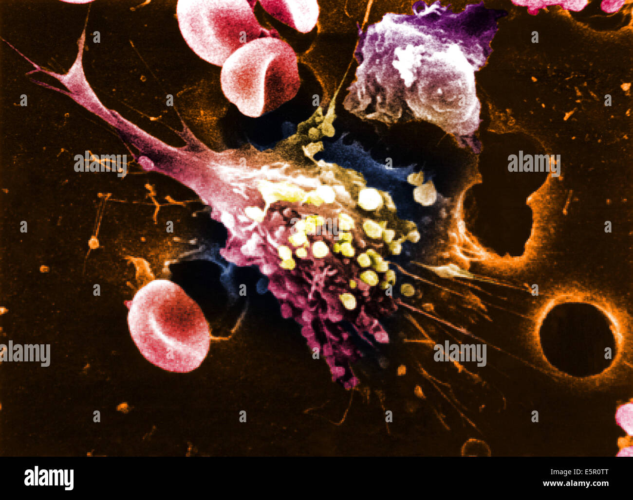 Scanning electron micrograph (SEM) of a cancer cell, Magnification ...