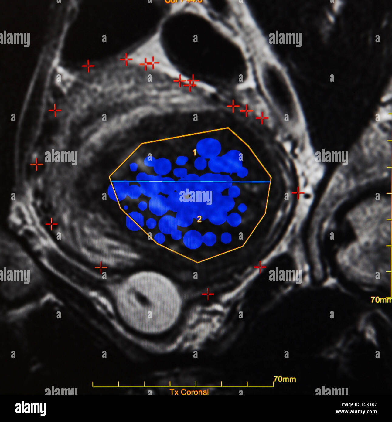 Uterine leiomyoma hi-res stock photography and images - Alamy
