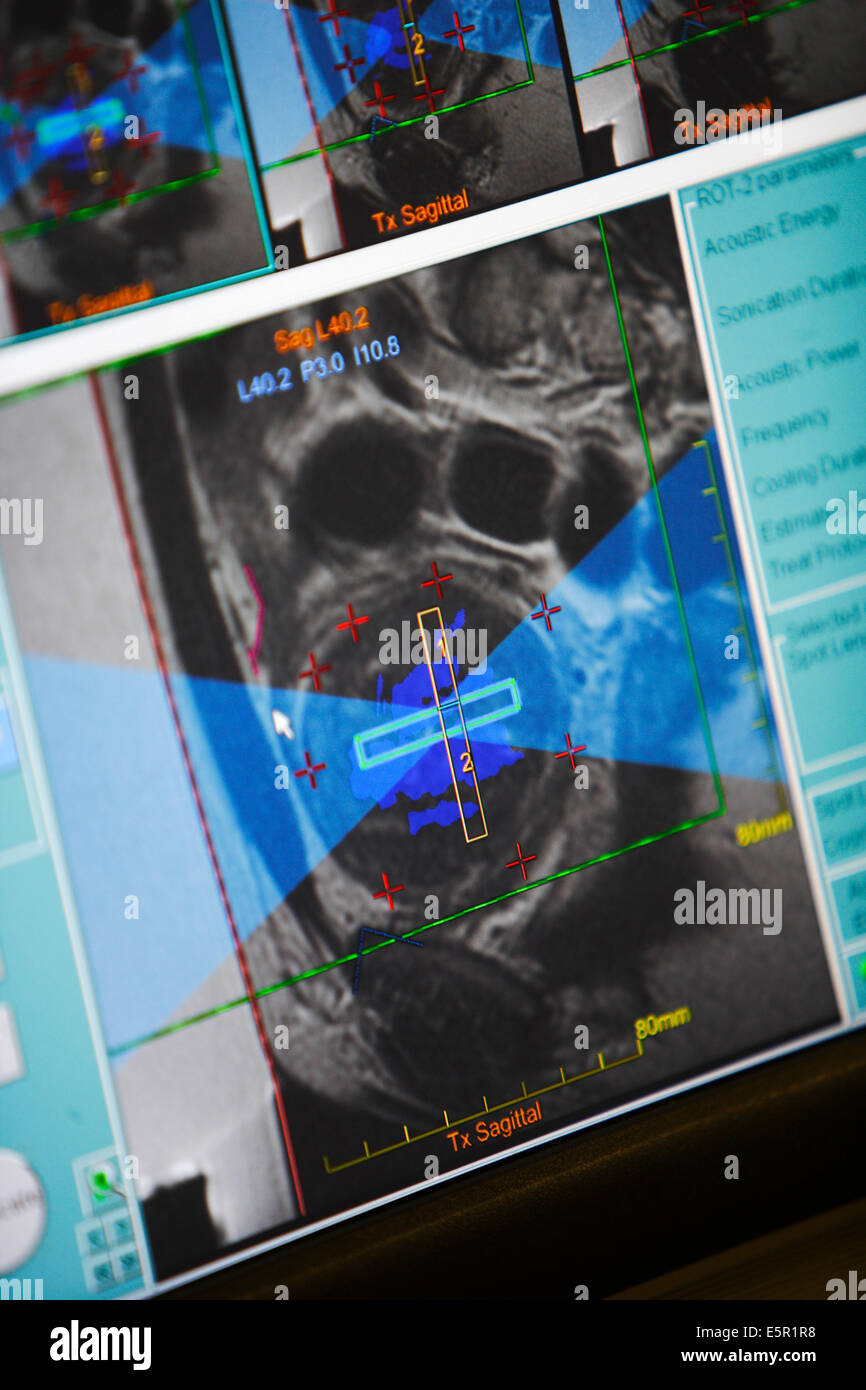 ExAblate® 2000 system with MR guided focused ultrasound uses a ...