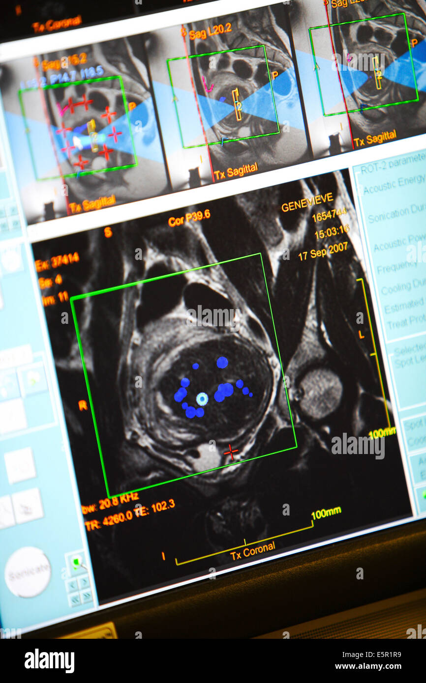 ExAblate® 2000 system with MR guided focused ultrasound uses a combination of high-intensity ...
