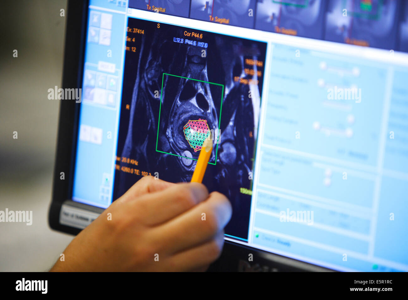 ExAblate® 2000 system with MR guided focused ultrasound uses a ...