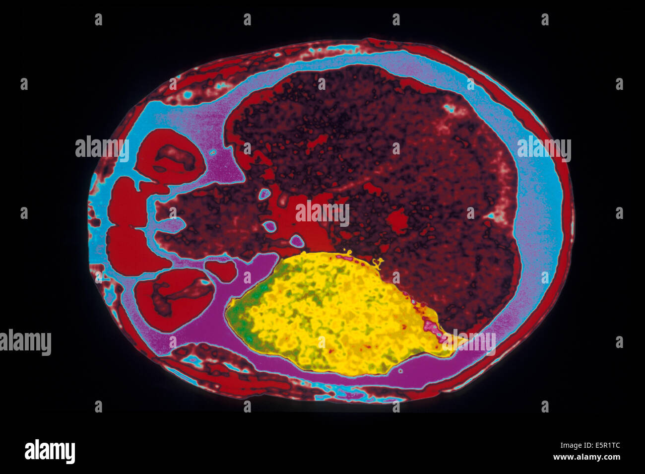 Coloured axial computed tomography (CT) scan of an adult's brain, showing encephalitis in the ...