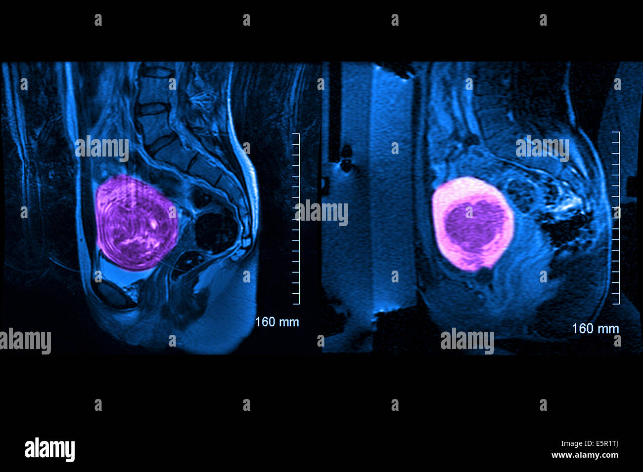 MRI of a uterine fibroma before treatment at left and fater at right, ExAblate® 2000 system with ...