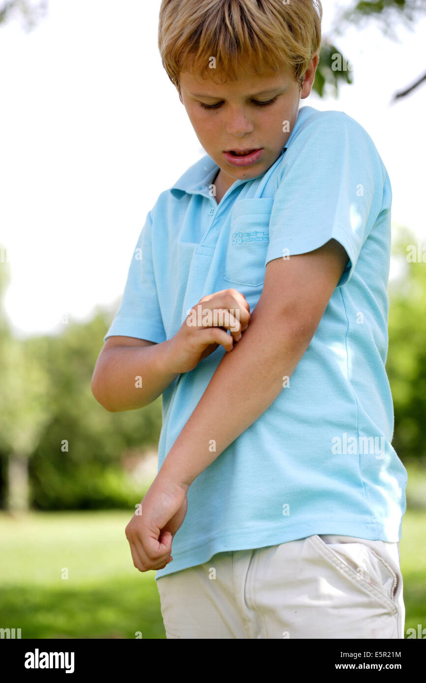 Boy scratching his arm following insect bite or plant sting Stock Photo ...