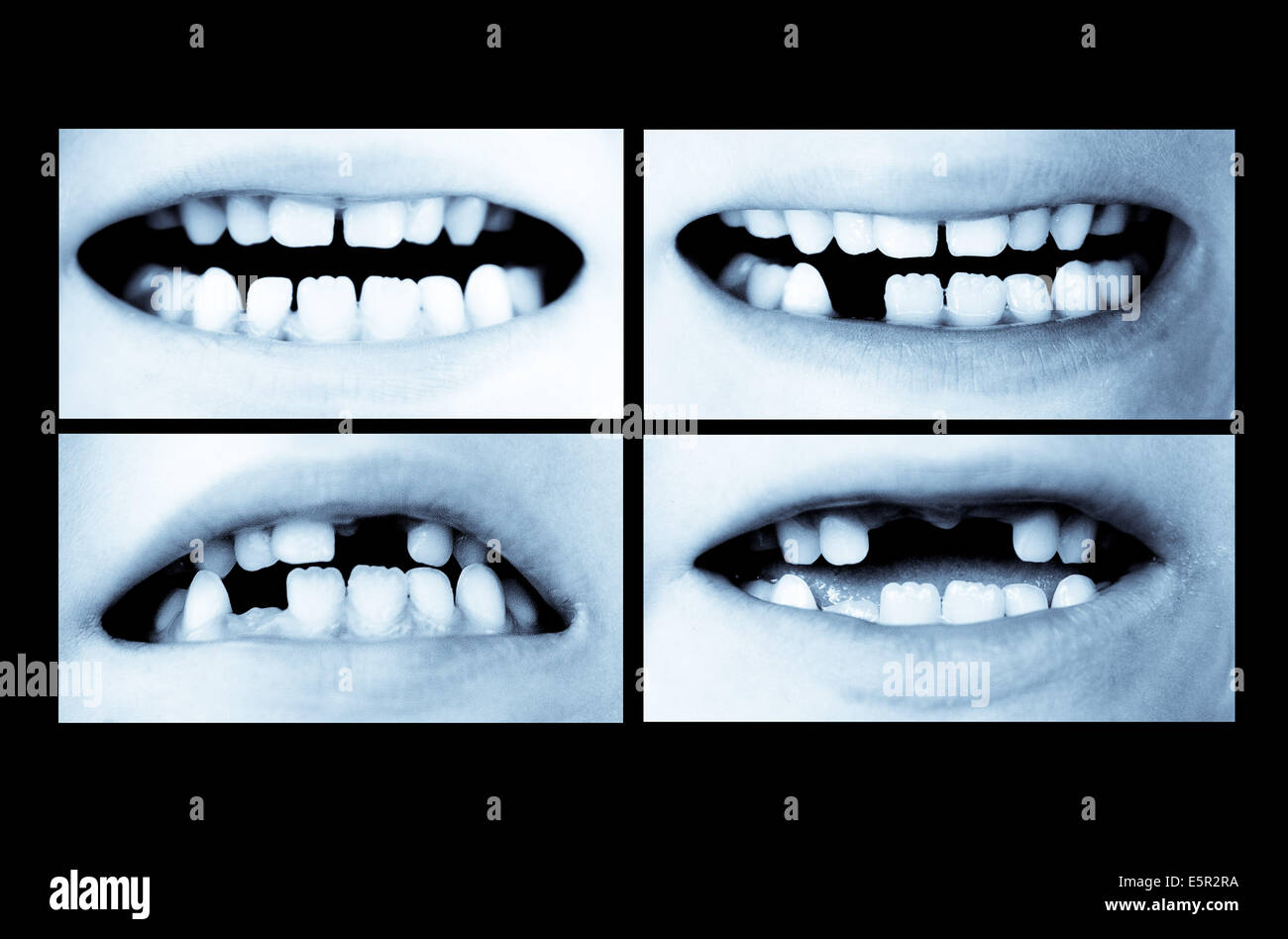 Child mouth close up teeth hi-res stock photography and images - Alamy