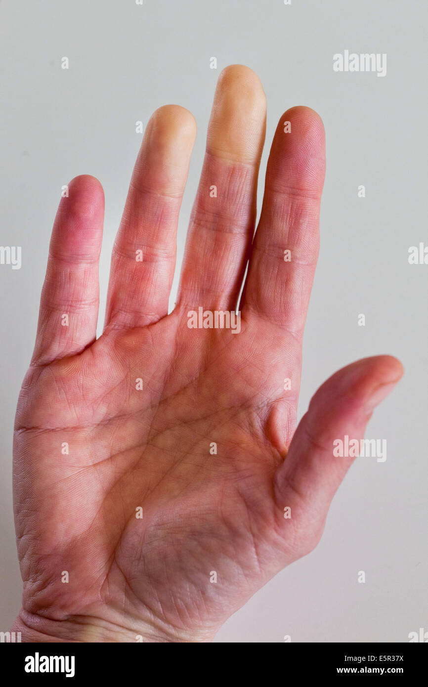 Raynauds hi-res stock photography and images - Alamy