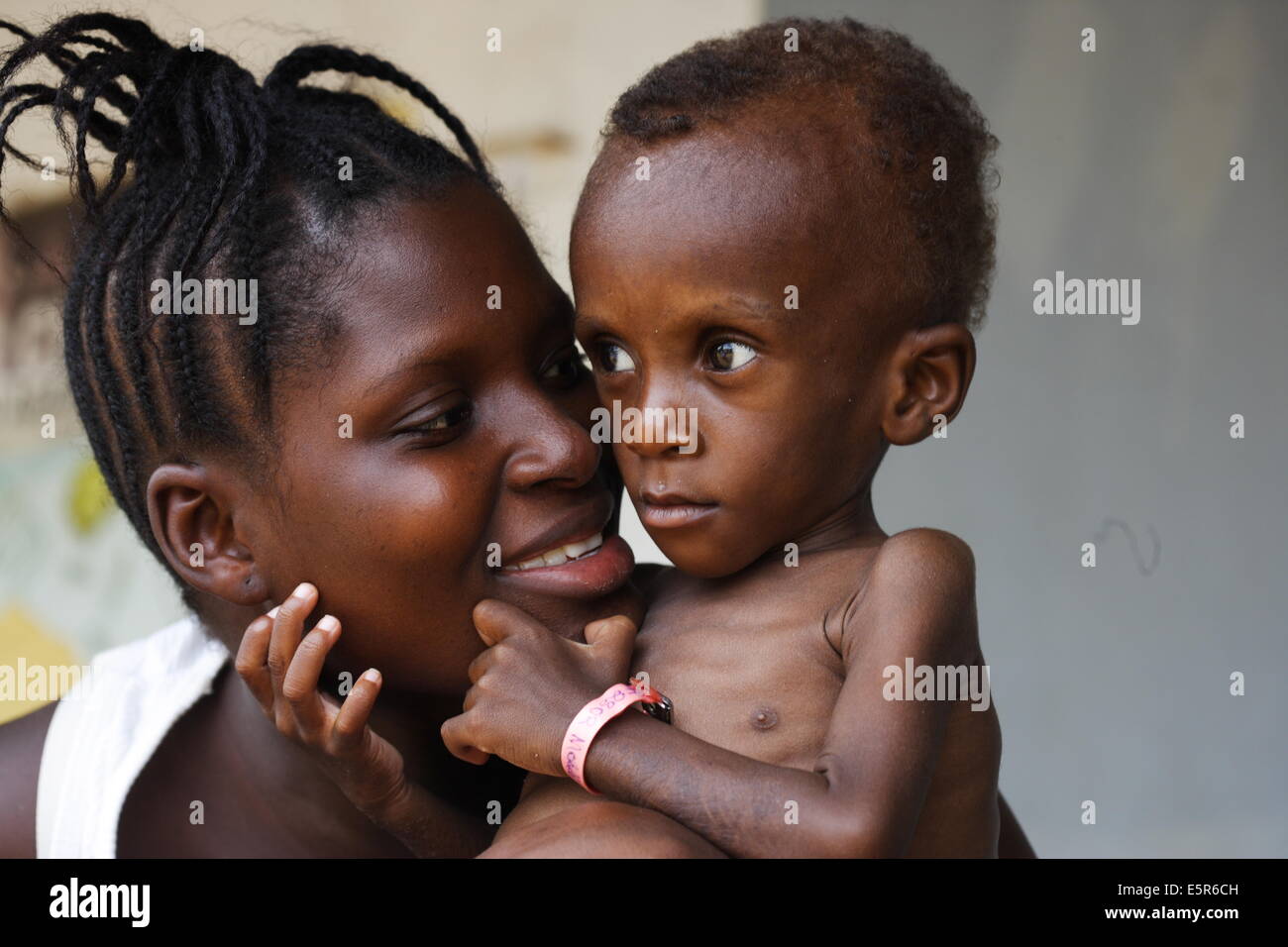 Marasmus hi-res stock photography and images - Alamy