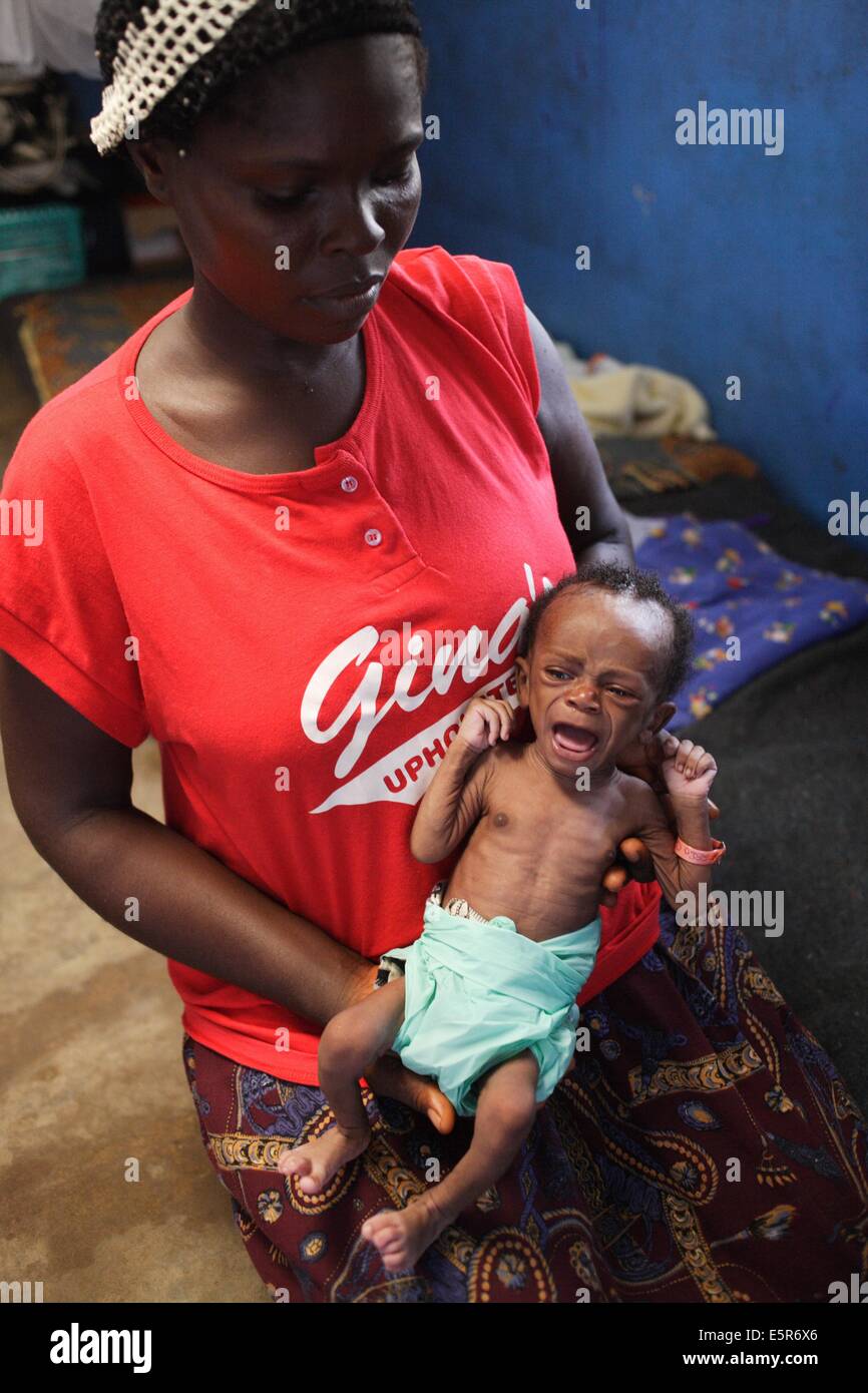 Woman with her undernourished child in a therapeutic feeding center in ...