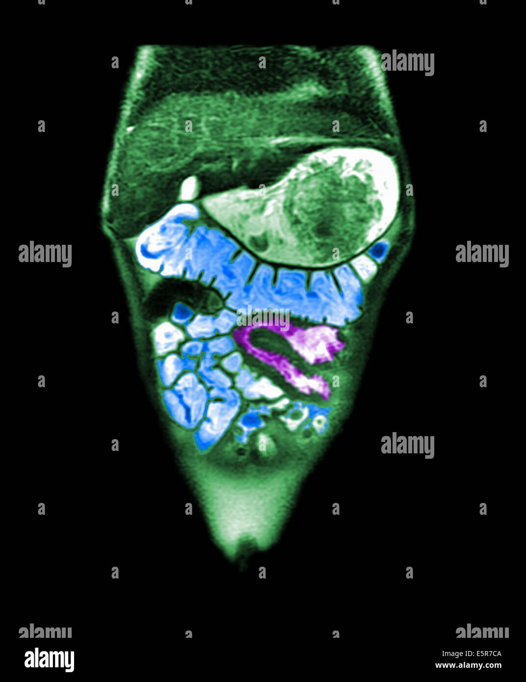 Colored MRI (Magnetic Resonance Imaging) of the small intestine of a 10 ...