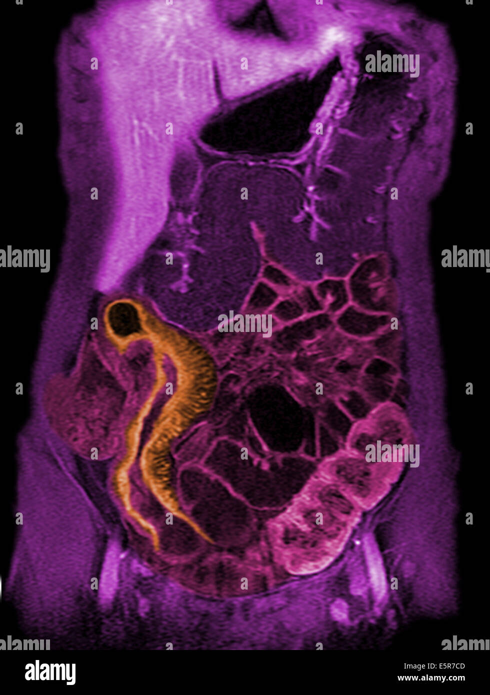 Colored MRI (Magnetic Resonance Imaging) of the small intestine of a 10 ...