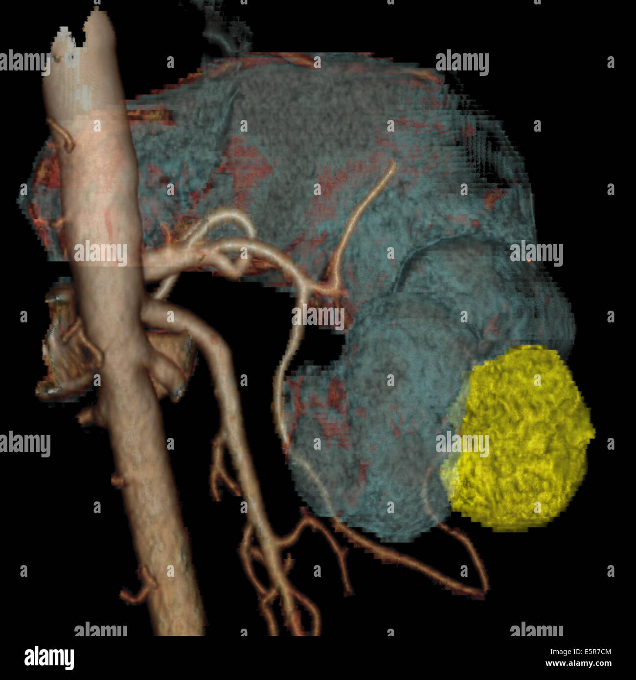 Three-dimensional computed tomographic reconstruction scan of the ...