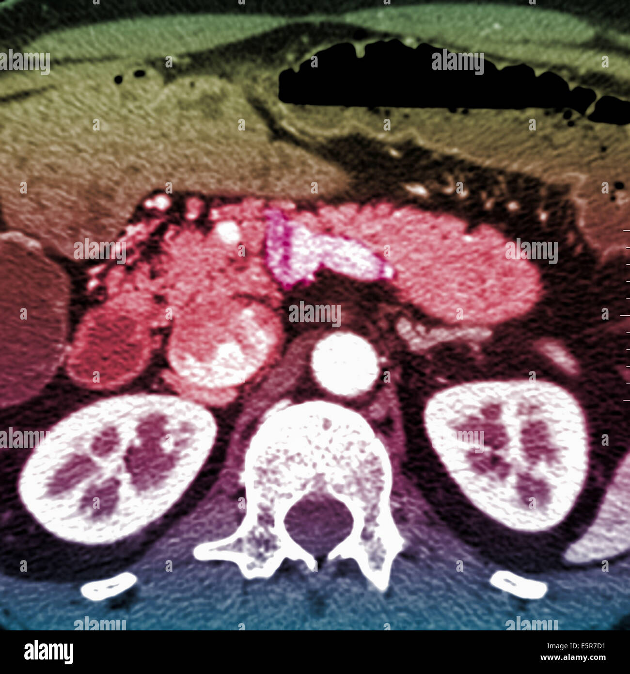 Ct scan abdomen hi-res stock photography and images - Alamy
