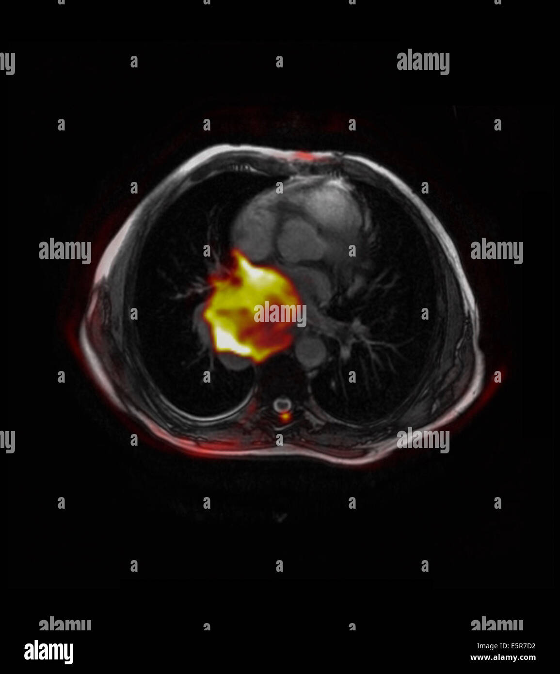 Colored MRI (Magnetic Resonance Imaging) scan showing a small cell lung ...
