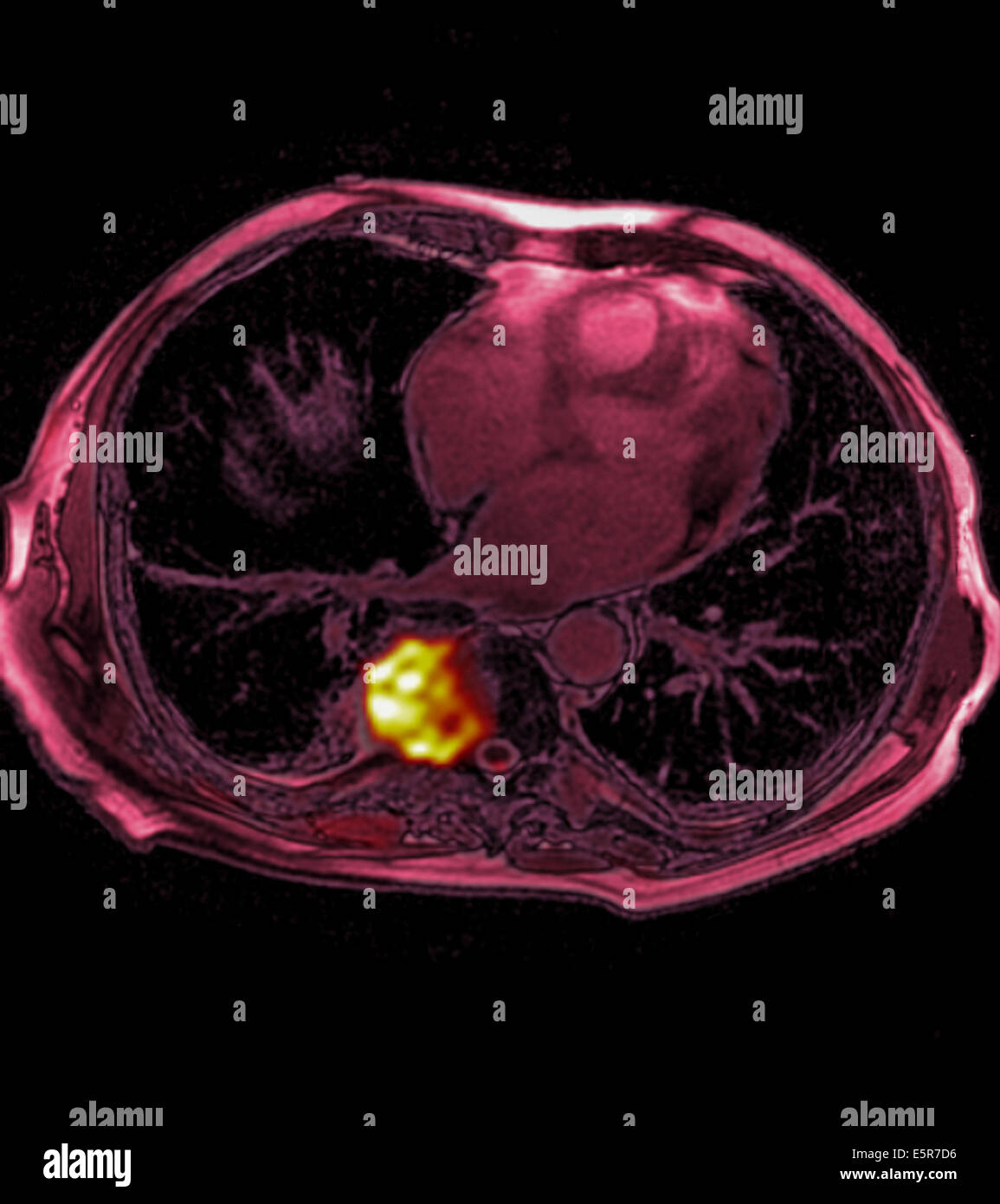 Colored MRI (Magnetic Resonance Imaging) scan showing a small cell lung ...