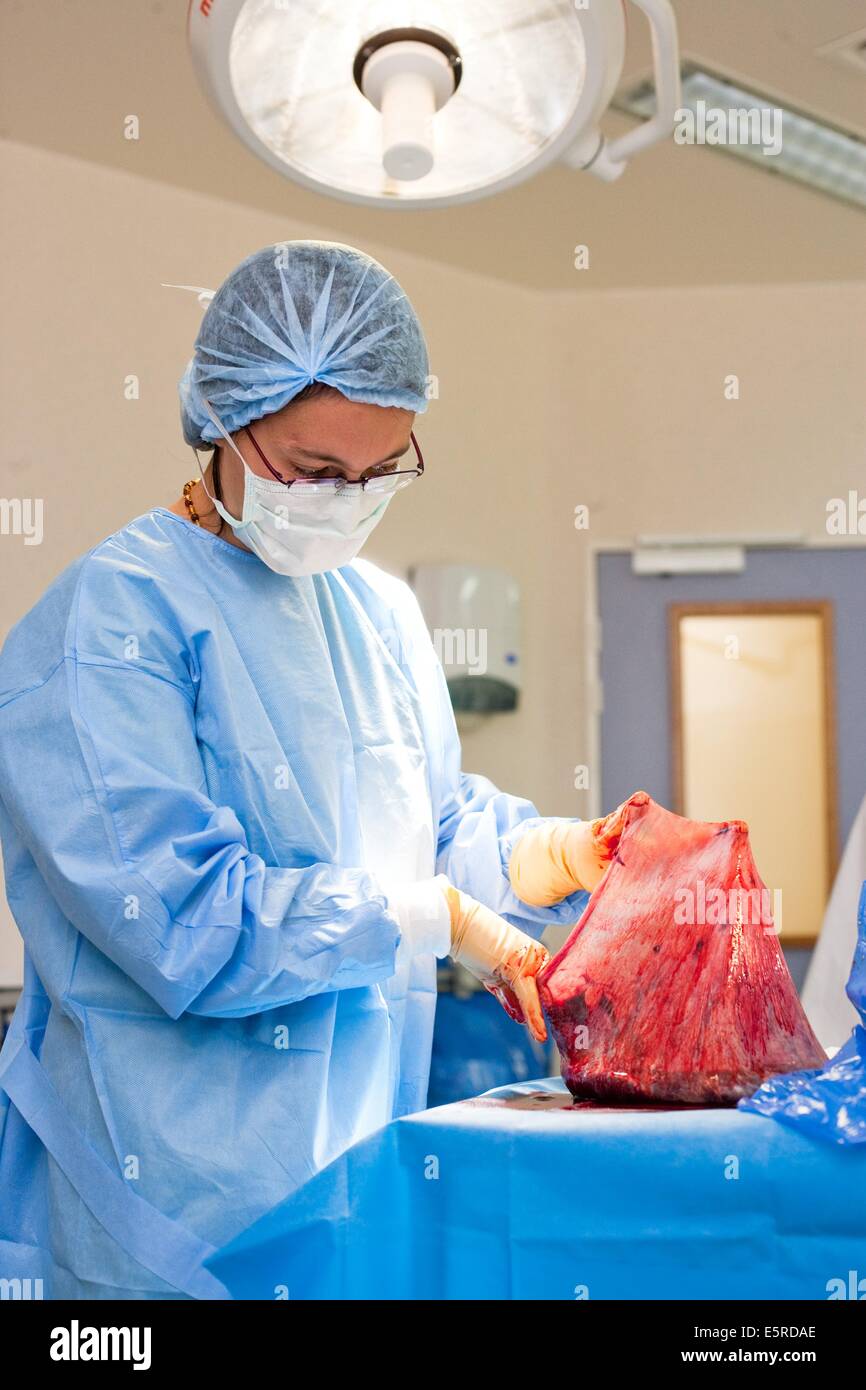 Human placenta after delivery, Obstetrics and gynaecology department ...