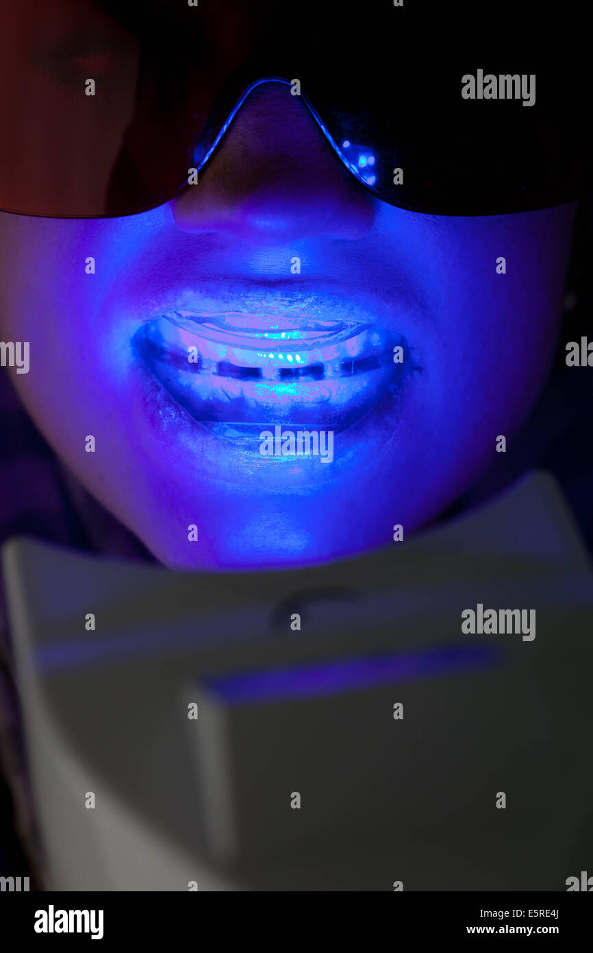 Smile bar. Teeth whitening by applying a gel. The active product placed ...