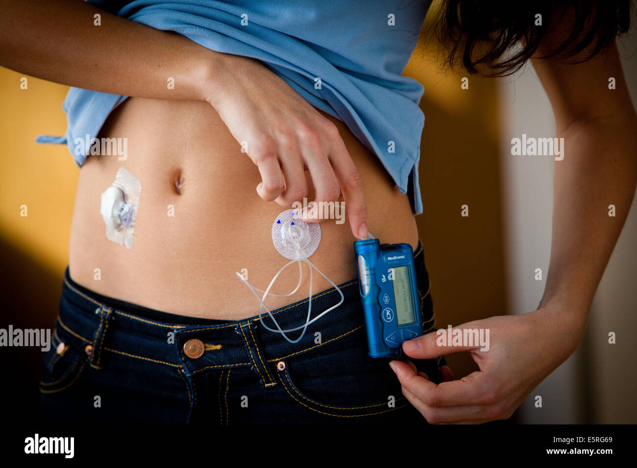 Insulin pump hi-res stock photography and images - Alamy