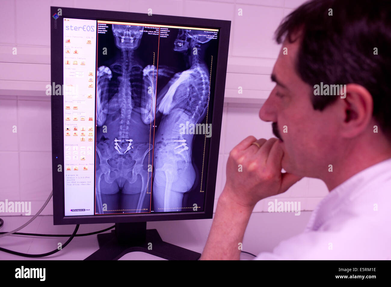 EOS biplanar X-ray scanner, this 2D and 3D digital X-ray imaging ...
