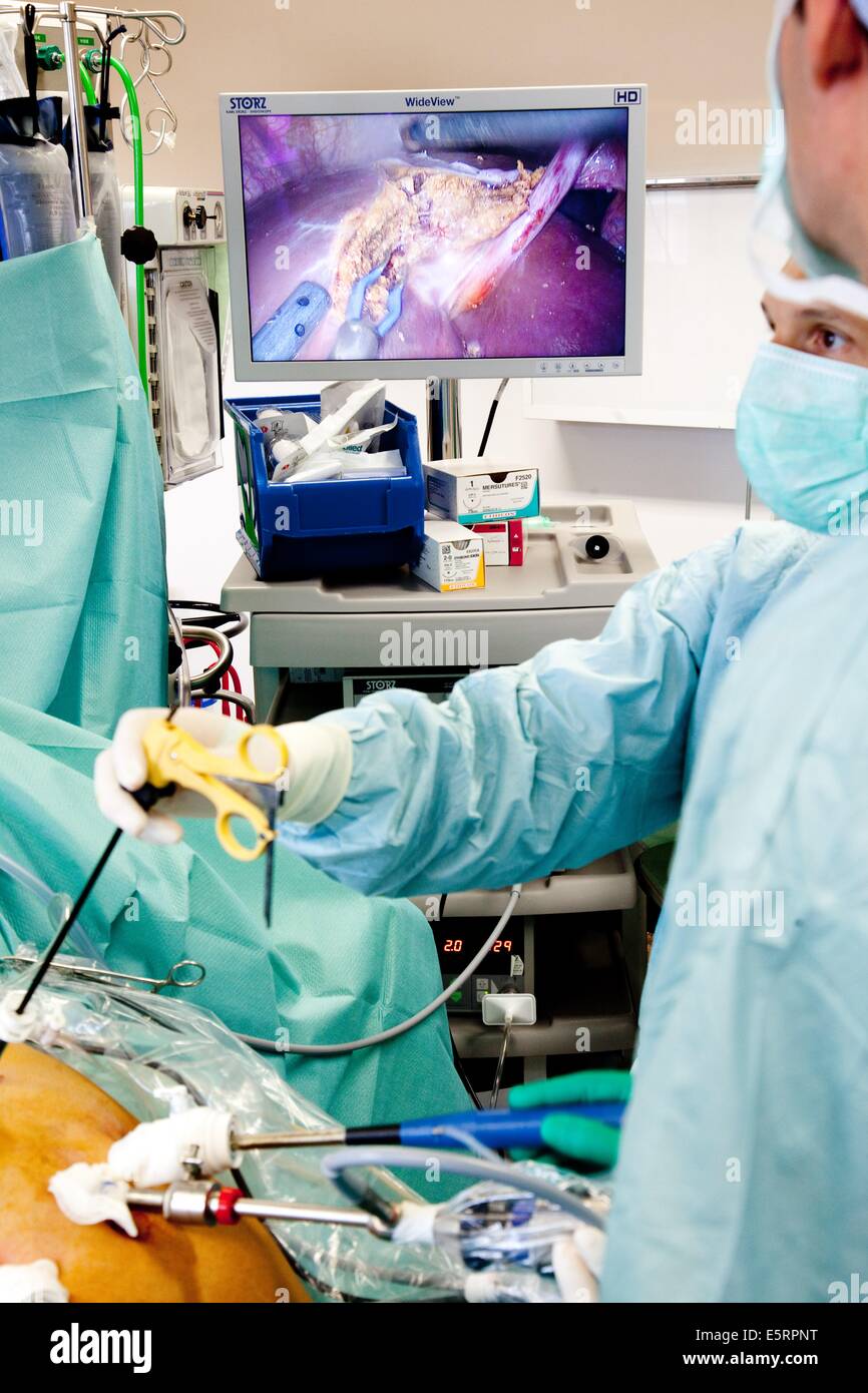 Partial removal of a liver from a living donor by laparoscopy for ...