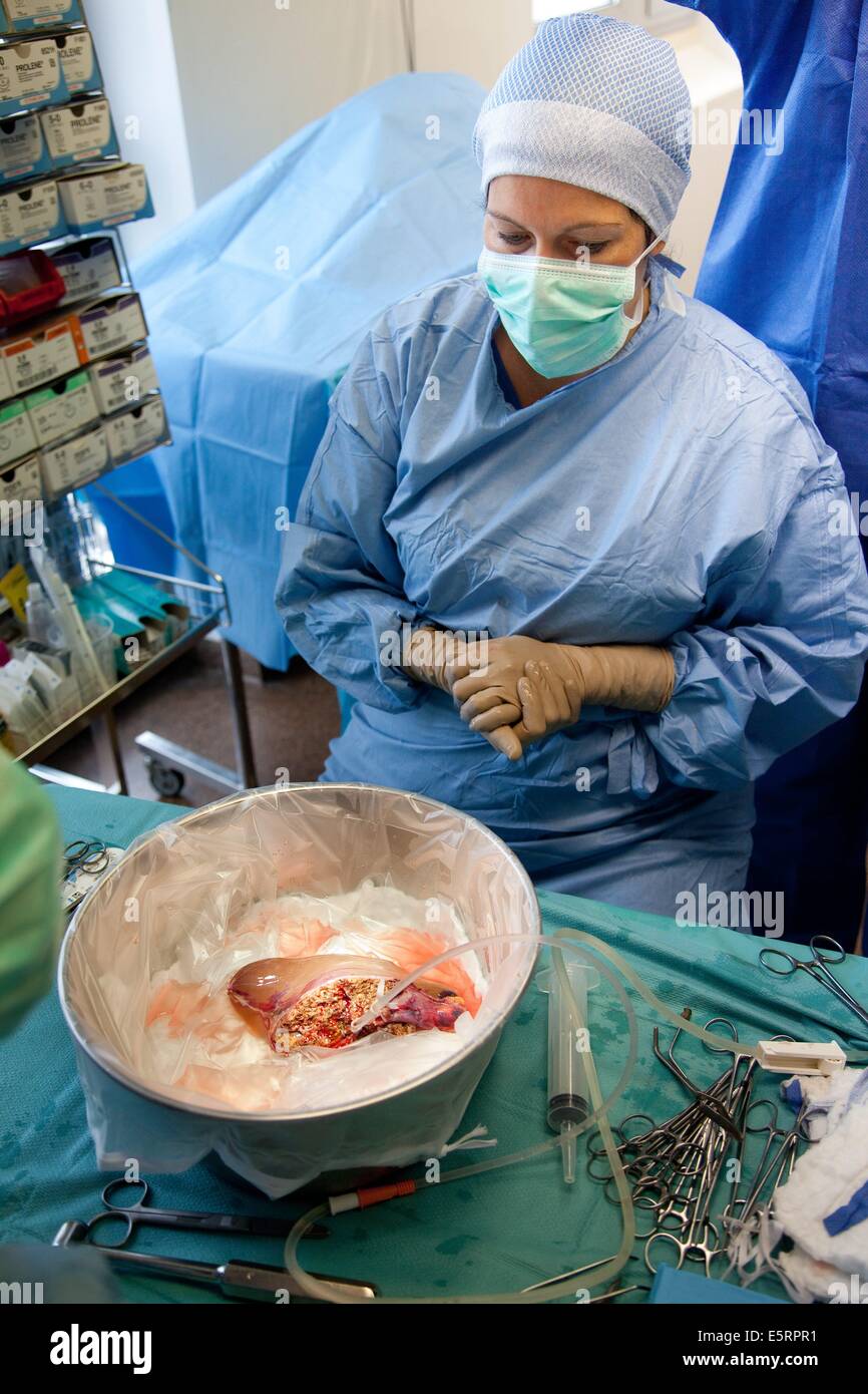 Partial removal of a liver from a living donor by laparoscopy for a ...