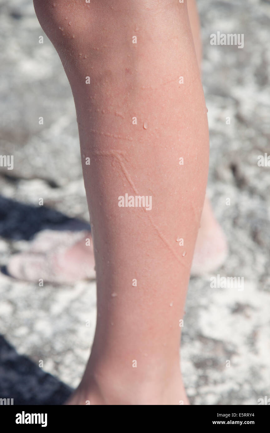 Jellyfish Stingers In Skin