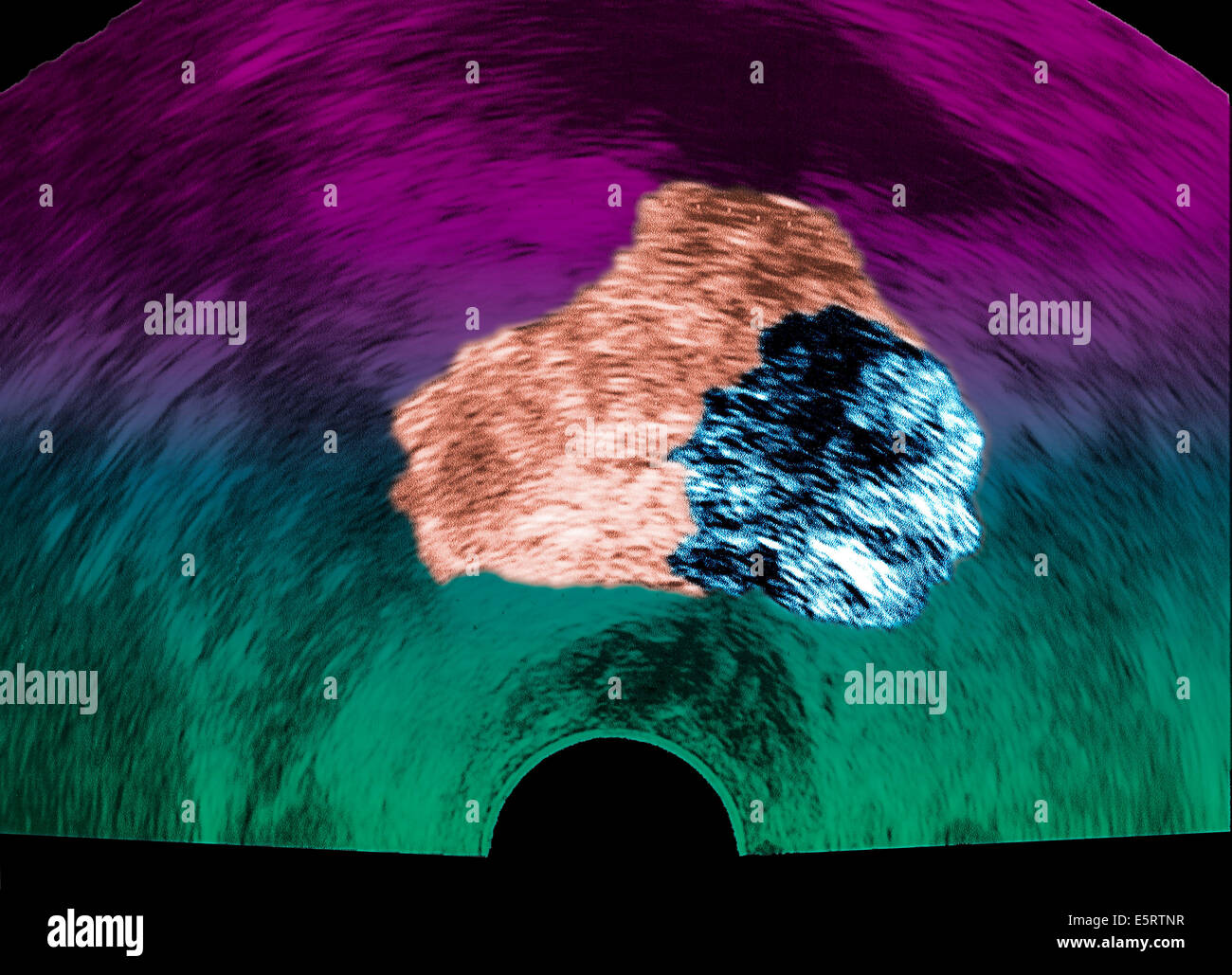 Ultrasound scan of a cancer of the prostate, seen in blue Stock Photo ...