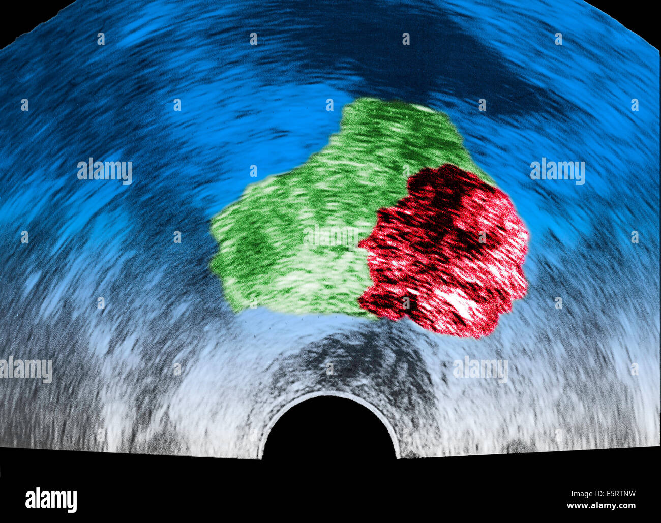 Ultrasound scan of a cancer of the prostate, seen in red Stock Photo ...