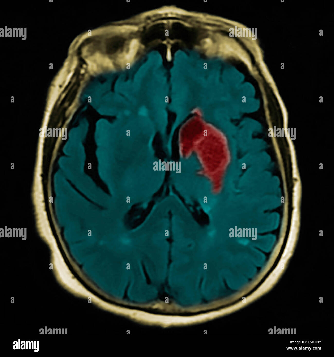 Cross section cerebrovascular accident hi-res stock photography and ...