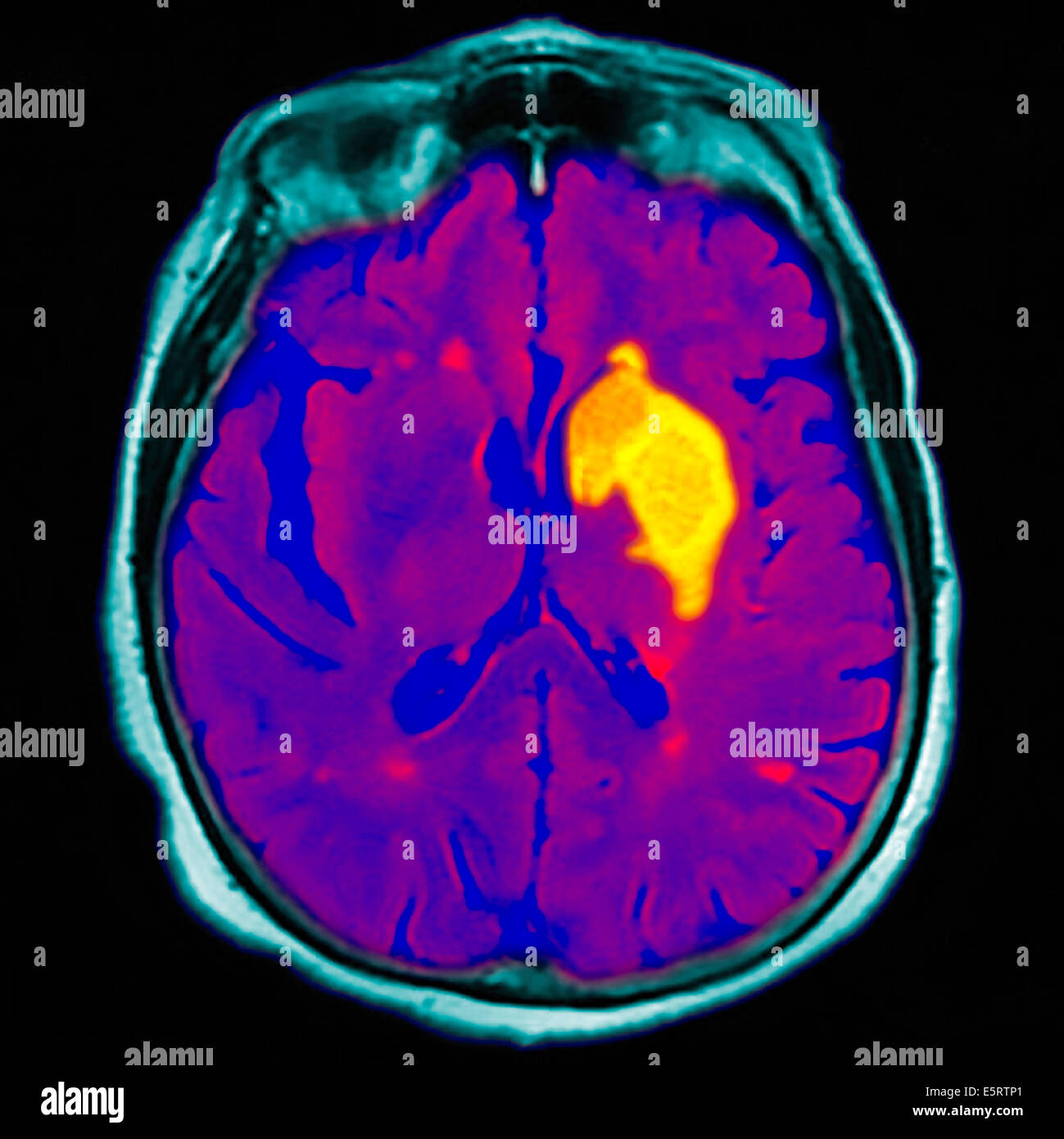Cerebrum cross section hi-res stock photography and images - Alamy