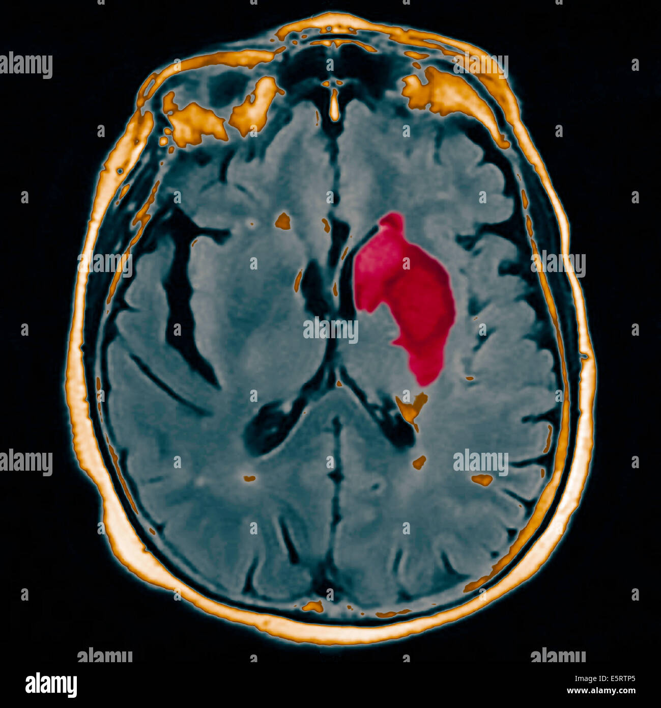 Coloured magnetic resonance imaging (MRI) scan and CT of an axial section through the brain of ...