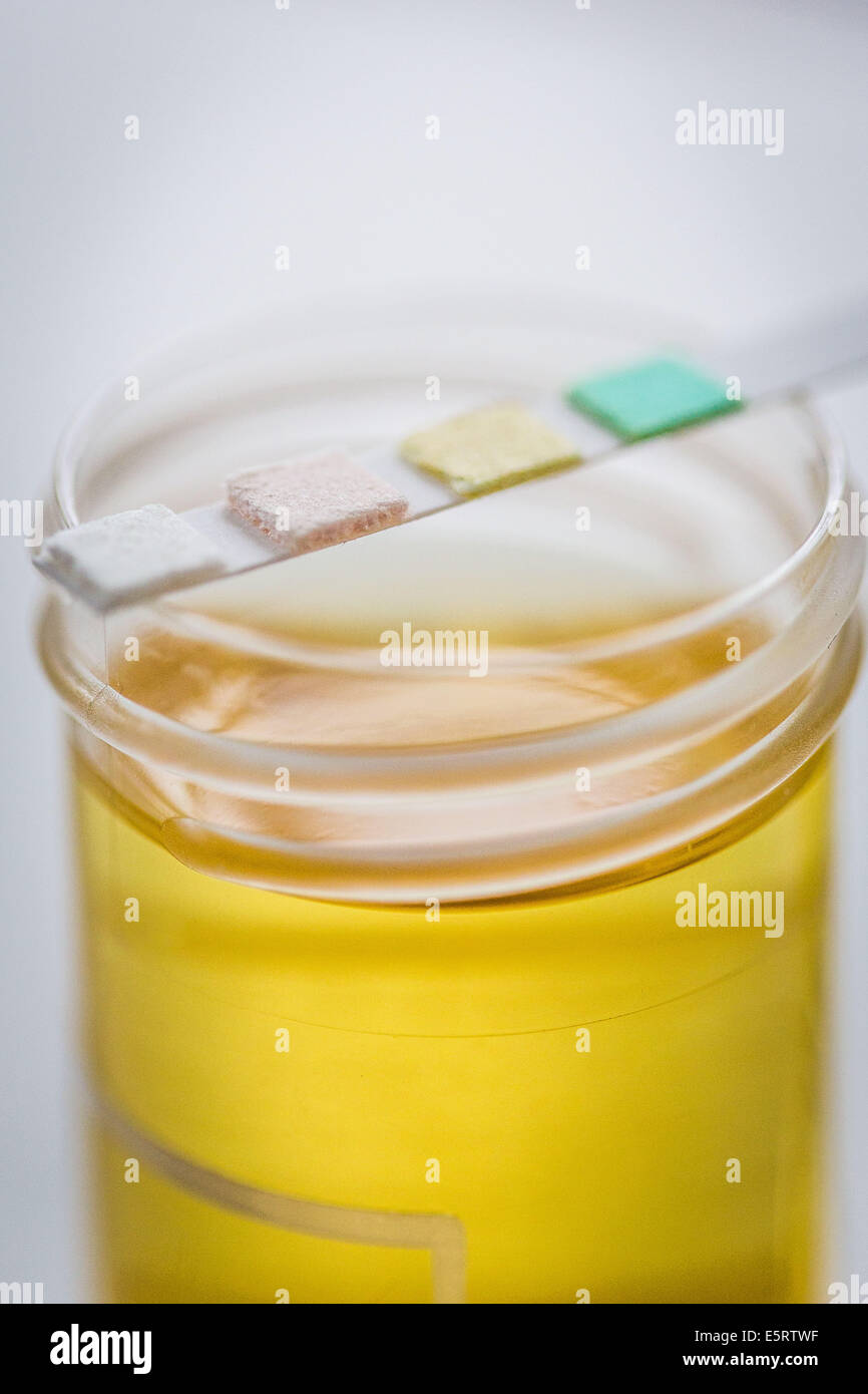 Urine sample with a test strip showing the results. This urine analysis ...