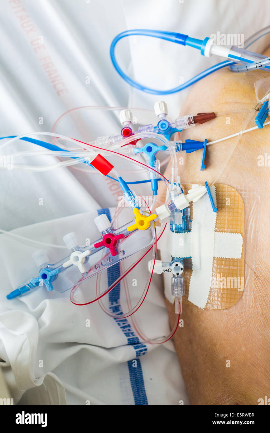 Multiple catheter, Intensive care department, Lagny Marne-la-Vallée ...