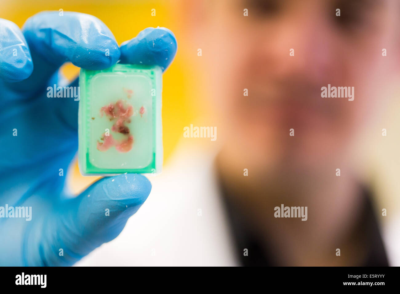 Tumor sample taken from patients in the anatomopathology diagnosis ...