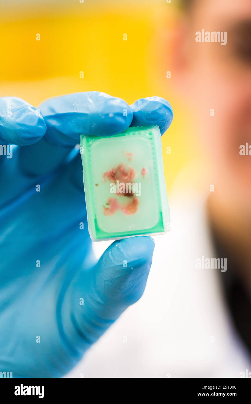 Tumor sample taken from patients in the anatomopathology diagnosis ...