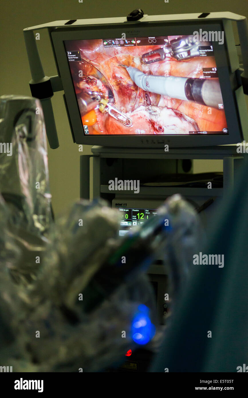 Hysterectomy performed by the telesurgery robot Da Vinci, which four ...