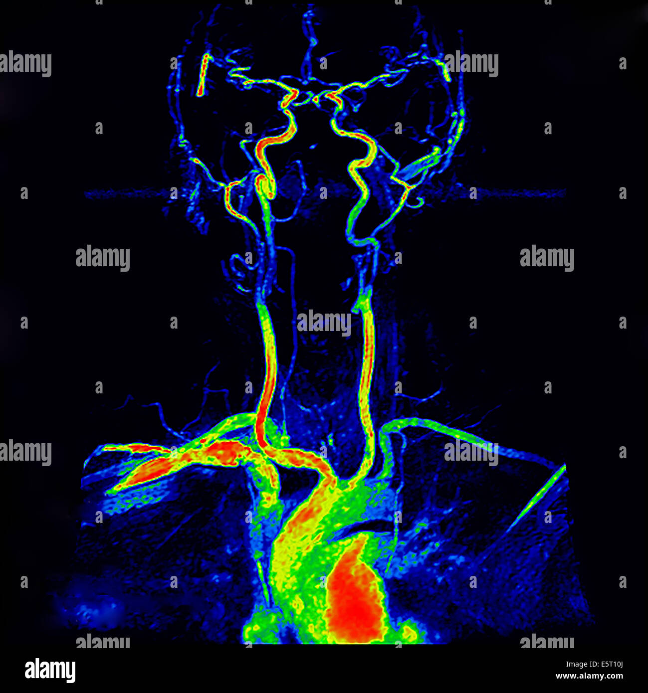 Supra-aortic trunks (TSA) showing the collateral branches of the aorta ...
