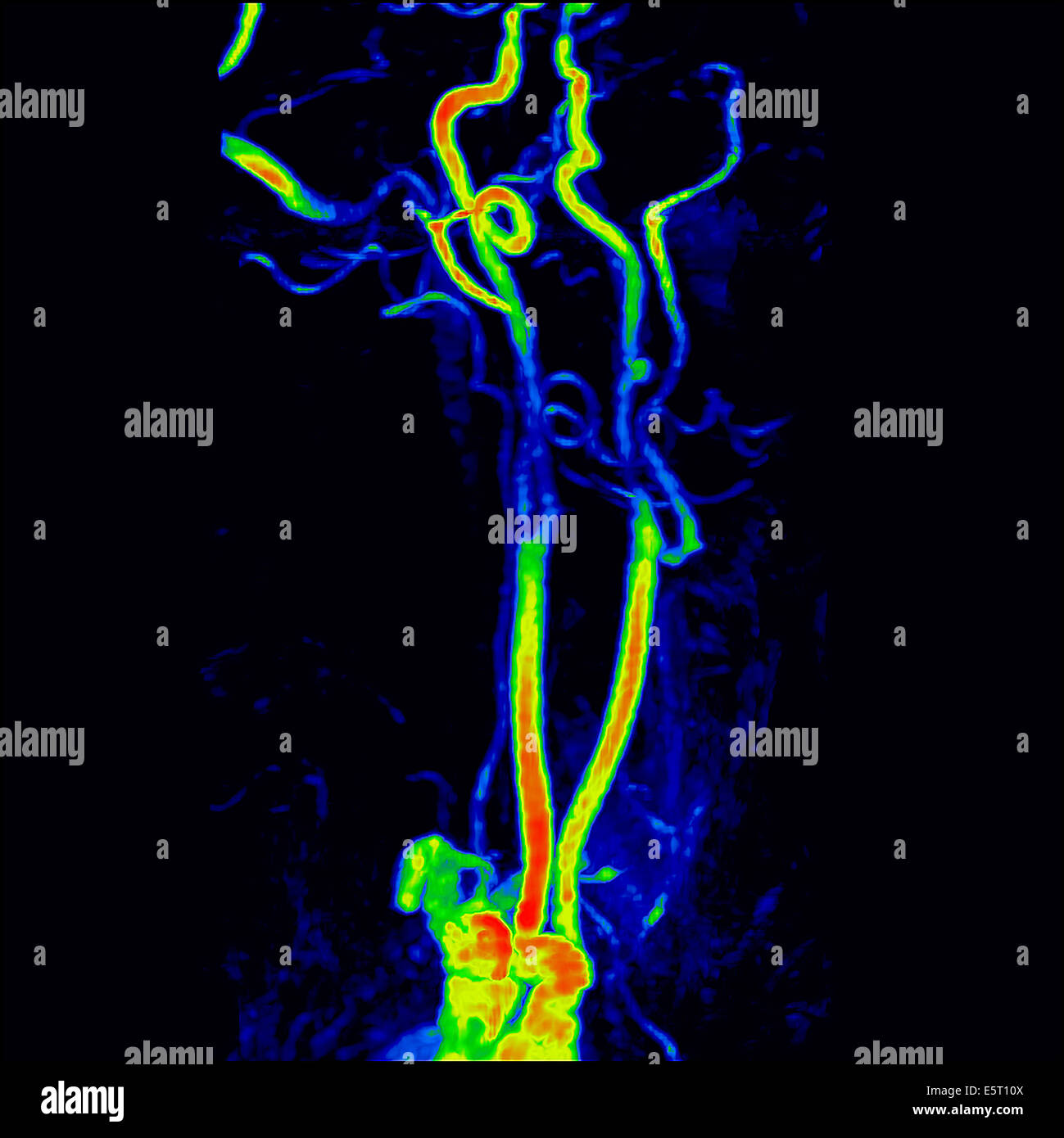 Supra-aortic trunks (TSA) showing the collateral branches of the aorta ...