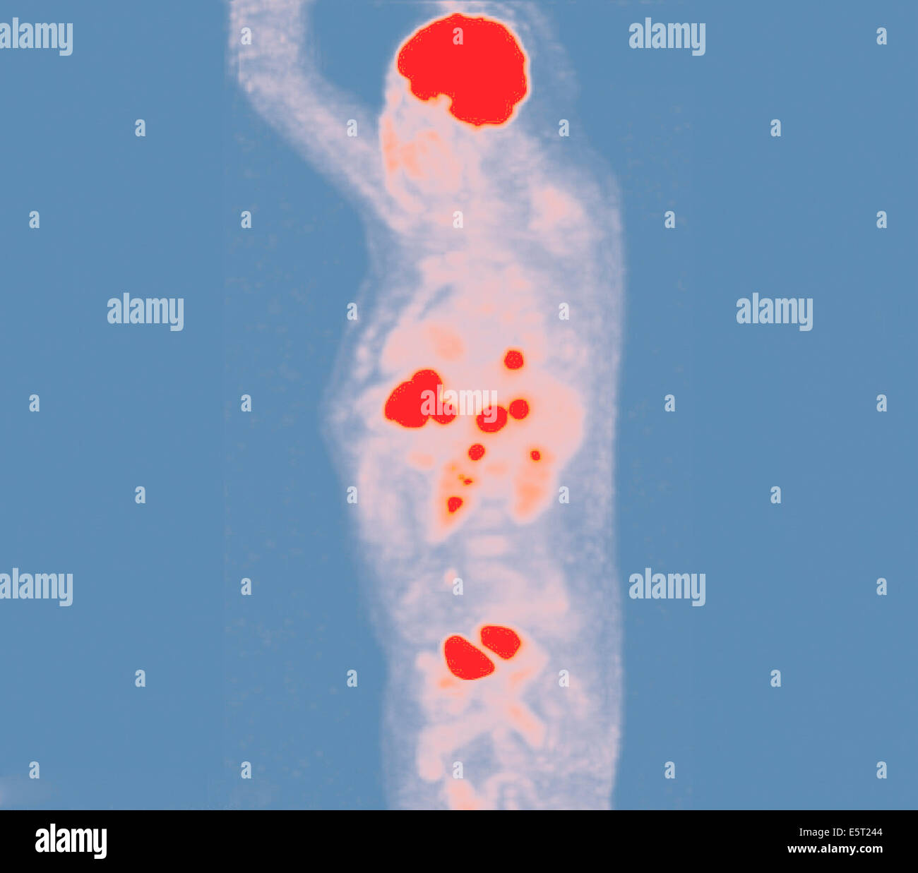 Pet scan cancer hi-res stock photography and images - Alamy