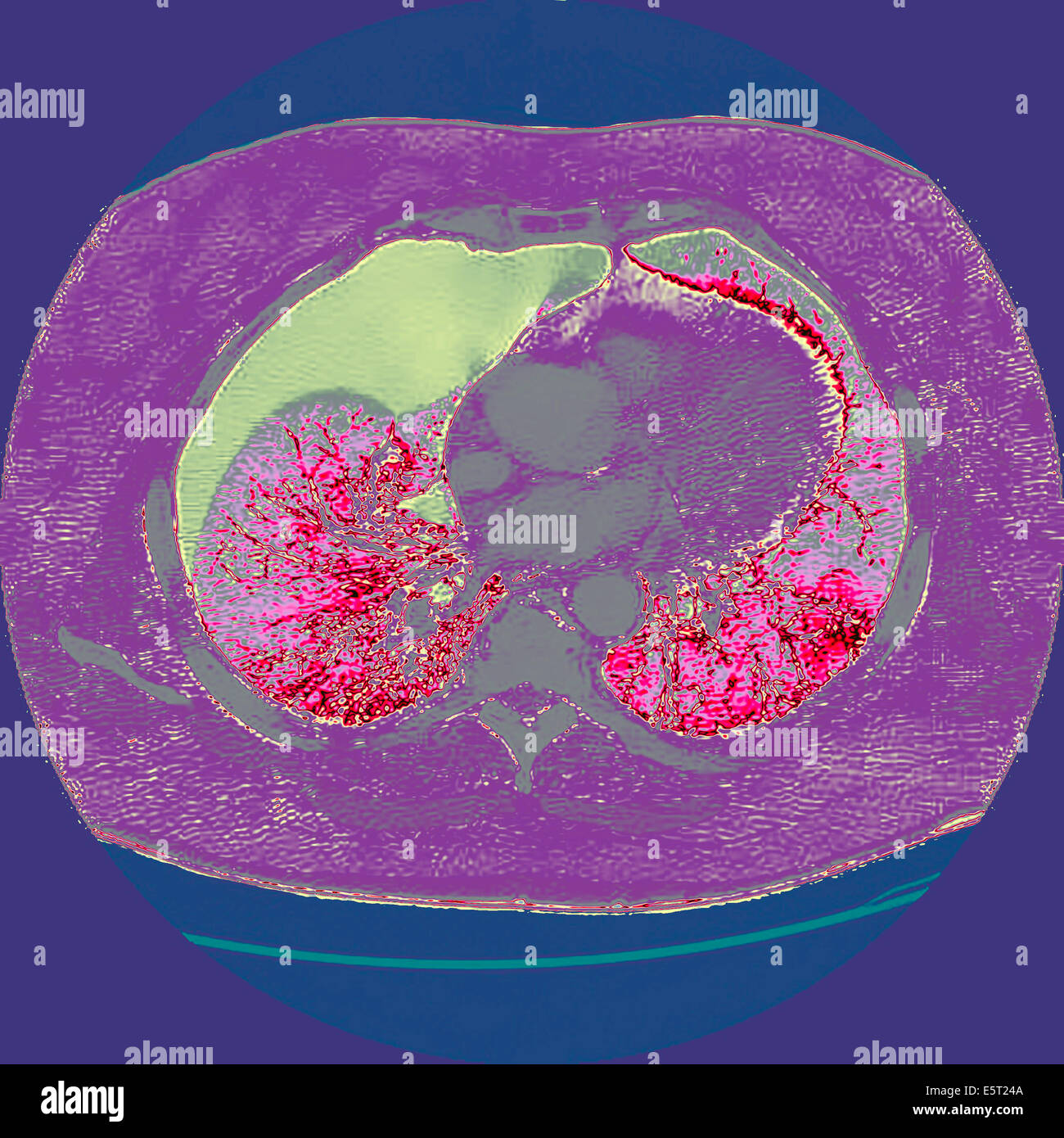 Collapsed lung High Resolution Stock Photography and Images - Alamy