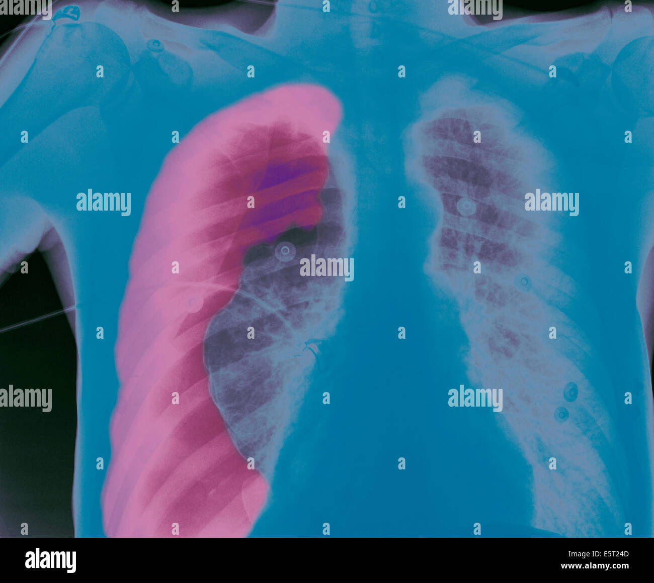 X-ray of the chest of a patient with a pneumothorax, or collapsed lung ...