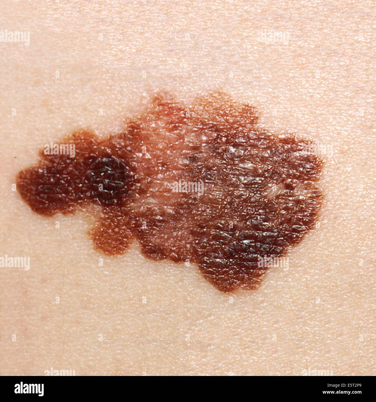 Melanoma on a patient's skin. An uneven (asymmetric) melanoma with an ...