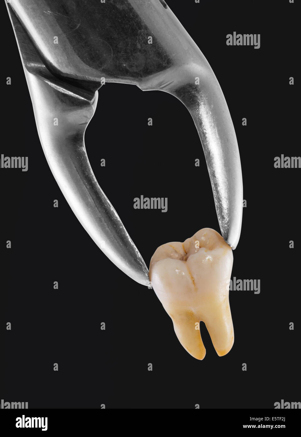 Tooth extraction hi-res stock photography and images - Alamy