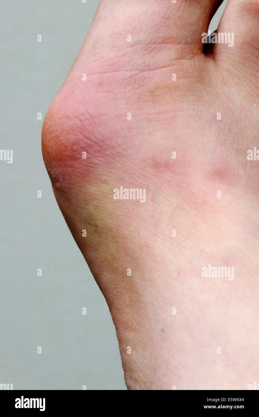 Deformity of human foot hallux valgus hi-res stock photography and ...