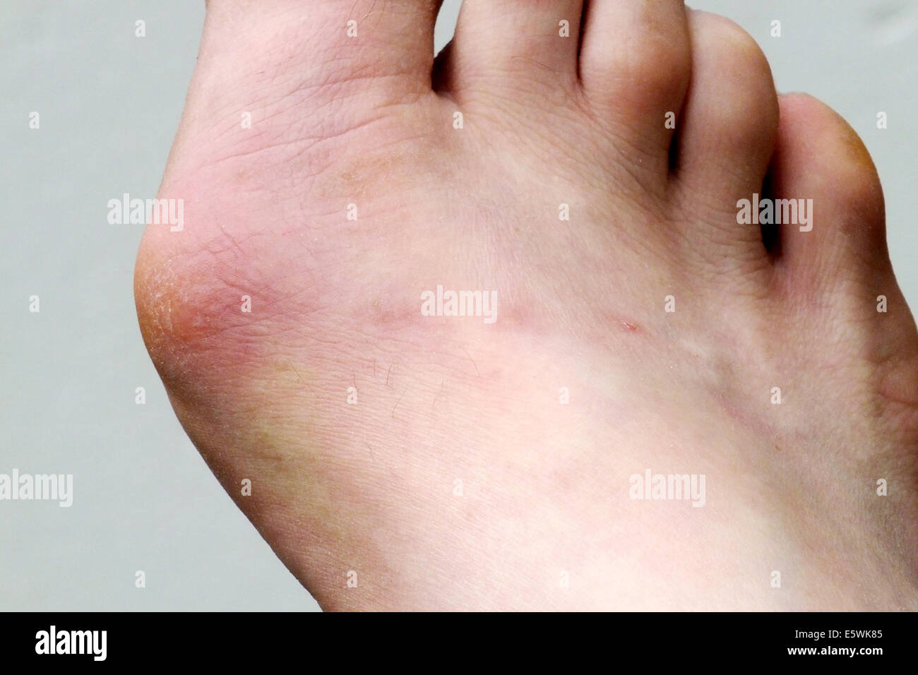 Deformity of human foot hallux valgus hi-res stock photography and ...