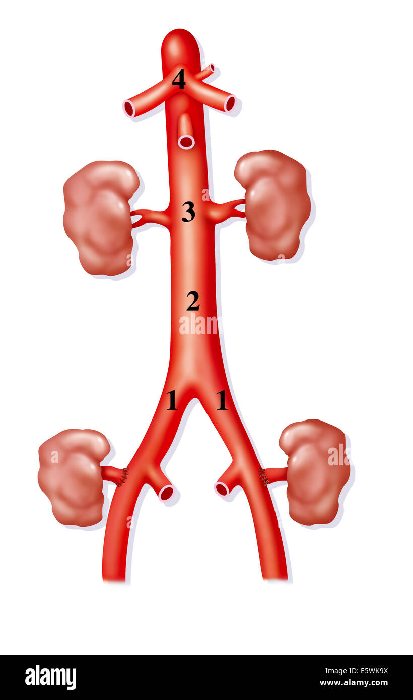 Common iliac artery hi-res stock photography and images - Alamy