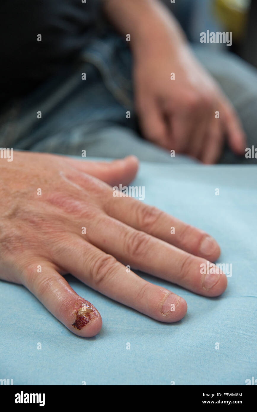 Paronychia infection hi-res stock photography and images - Alamy